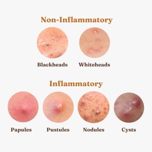 Understanding Acne: Causes, Types, And Treatments | Radiant Facial ...